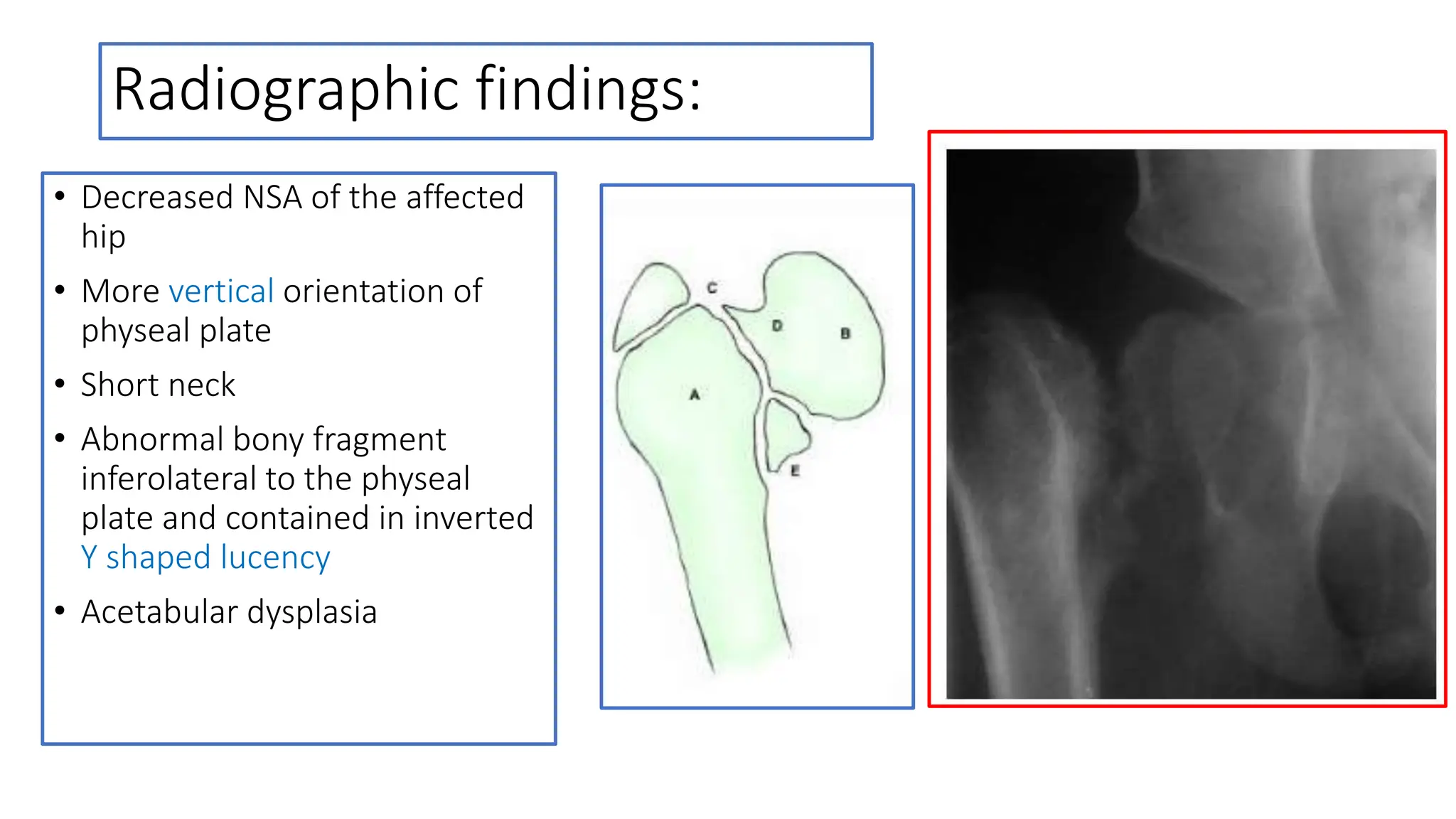 COXA VARA AND COXA VALGA, DEVLOPMENTAL COXA VARA.pptx