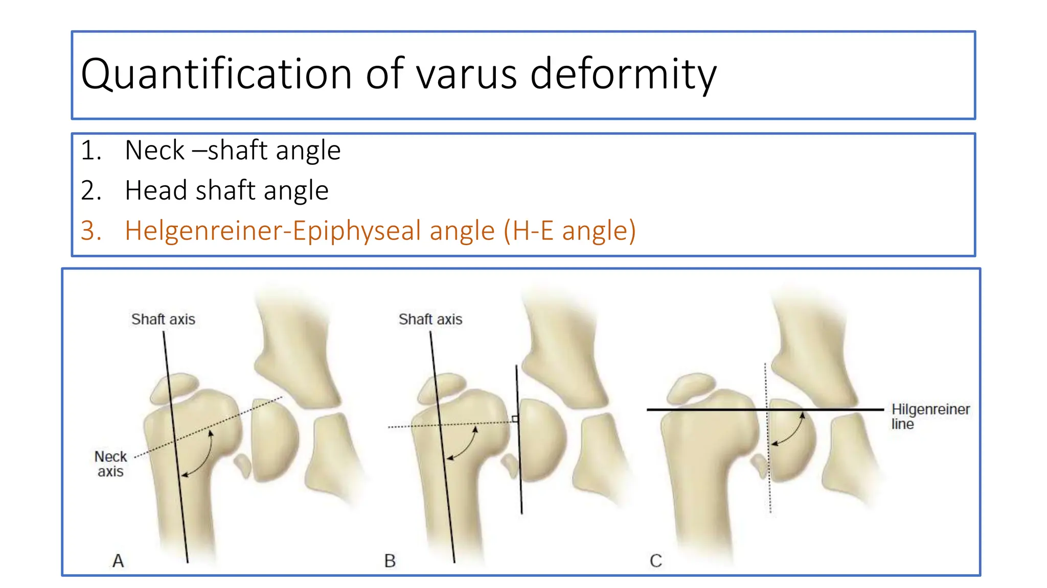 COXA VARA AND COXA VALGA, DEVLOPMENTAL COXA VARA.pptx