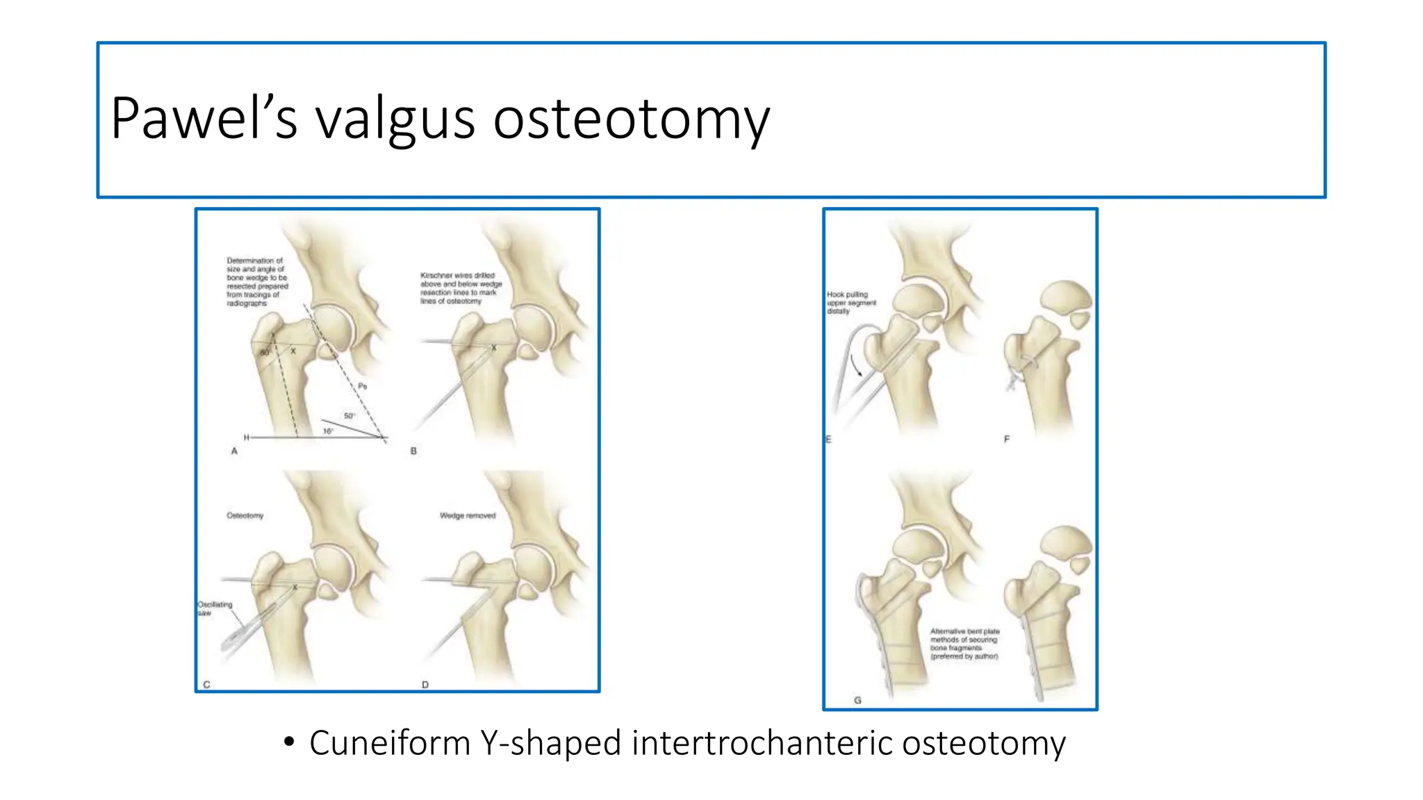 COXA VARA AND COXA VALGA, DEVLOPMENTAL COXA VARA.pptx