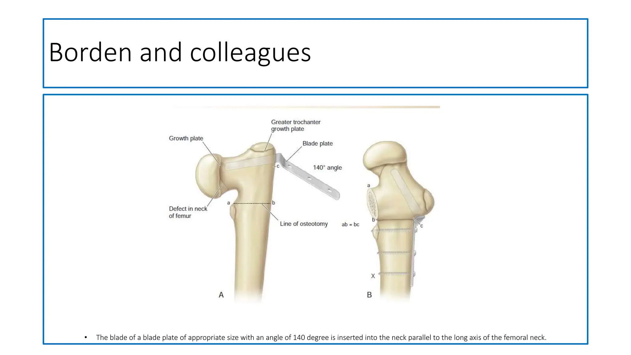 COXA VARA AND COXA VALGA, DEVLOPMENTAL COXA VARA.pptx
