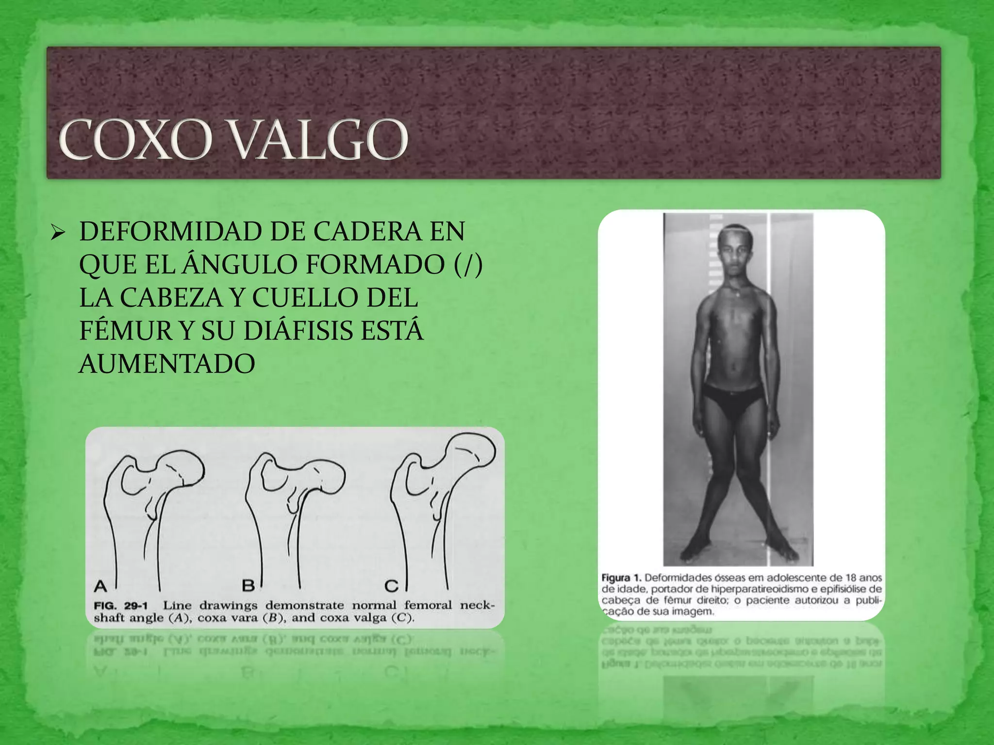 Coxo valga y varo
