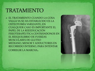 Coxo valga y varo | PPTX
