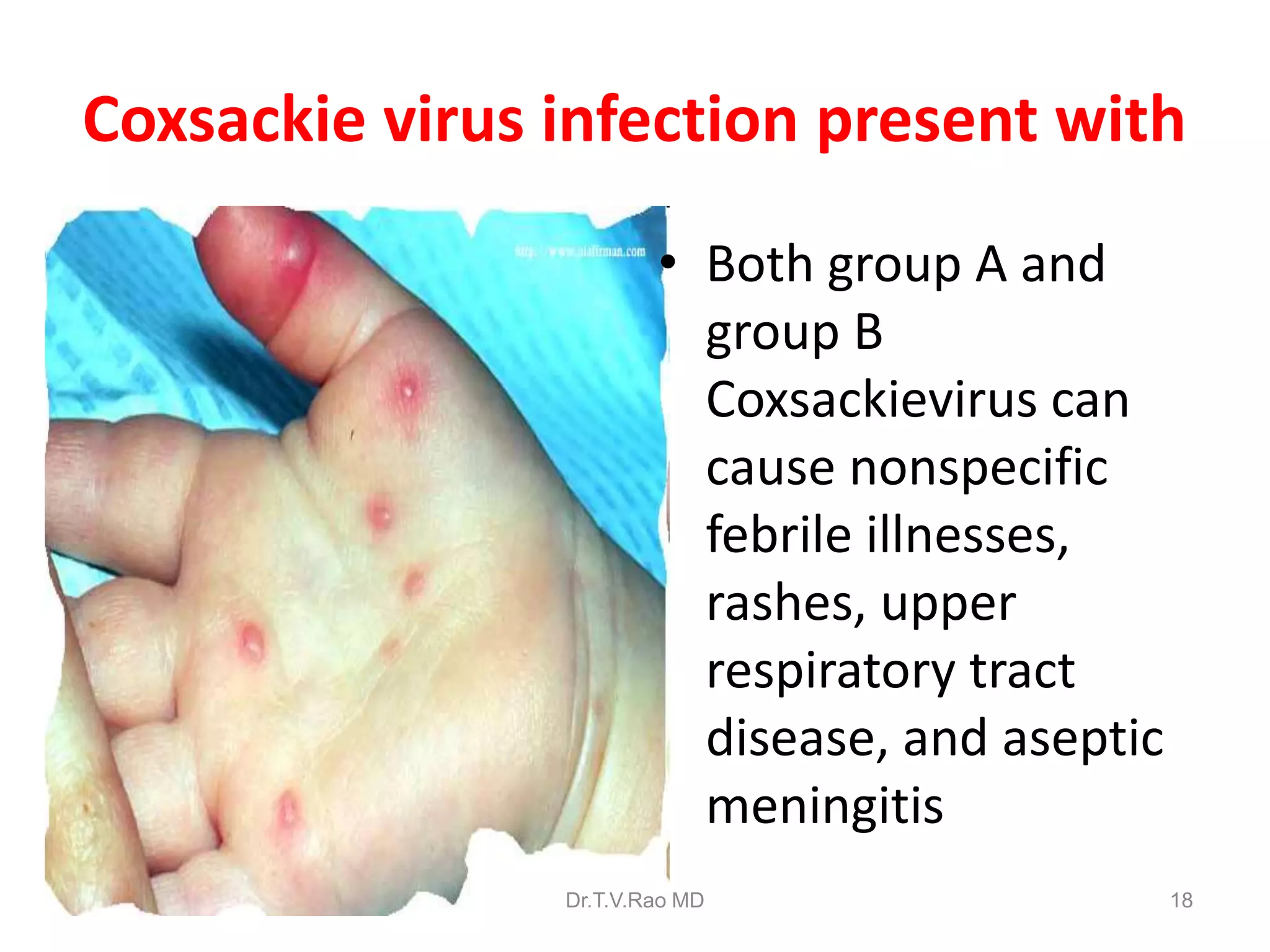Coxsackievirus (2).ppt