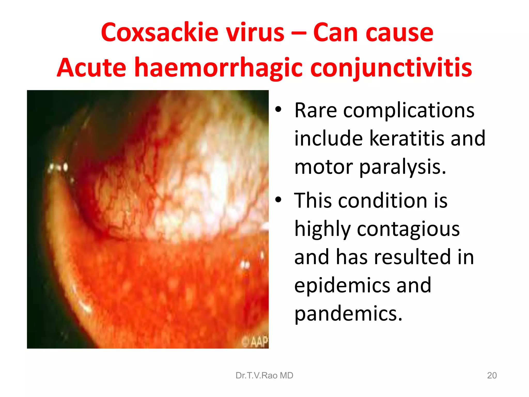 Coxsackievirus (2).ppt