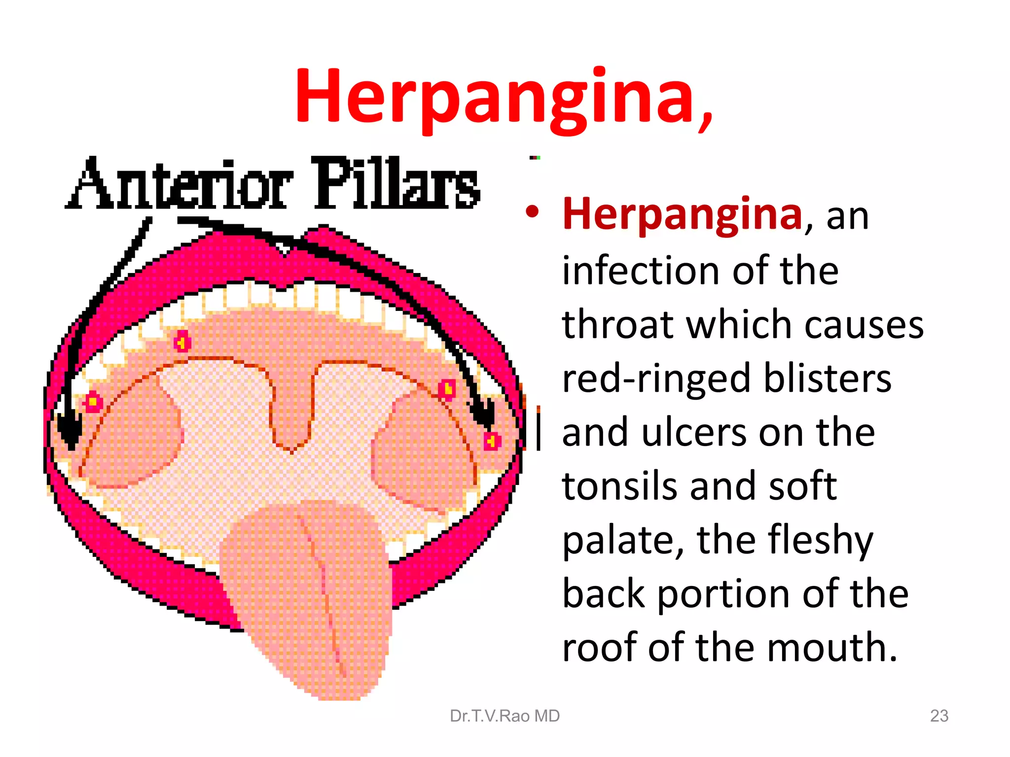 Coxsackievirus (2).ppt