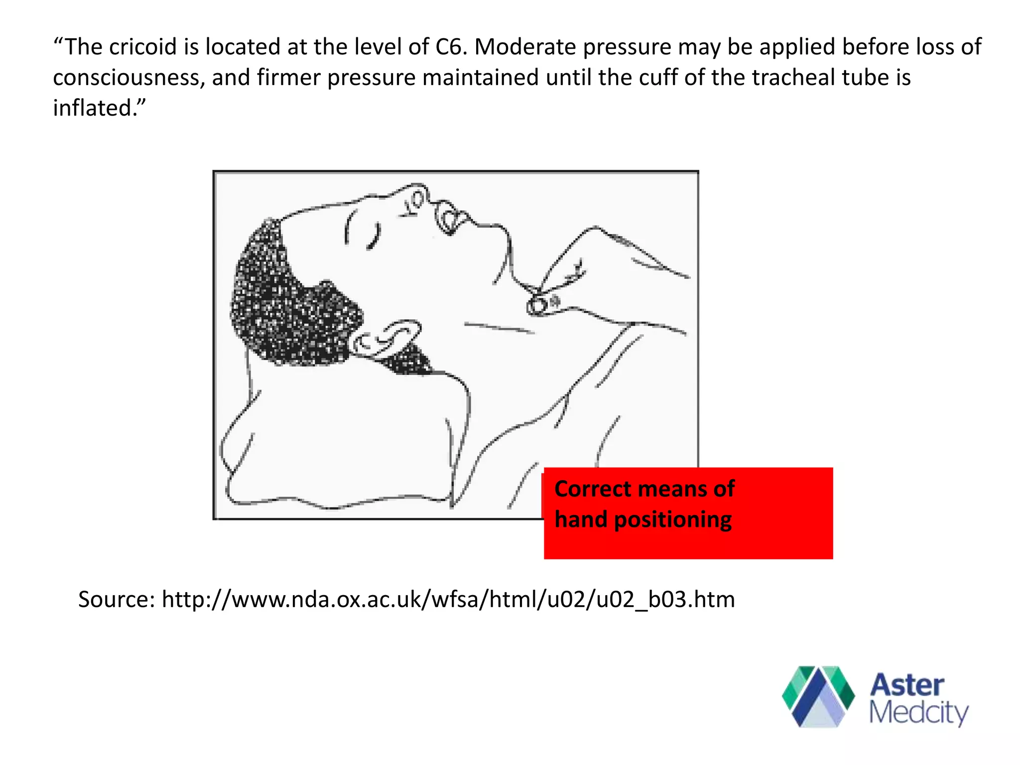 Cricoid pressure -Yes or No? | PPTX