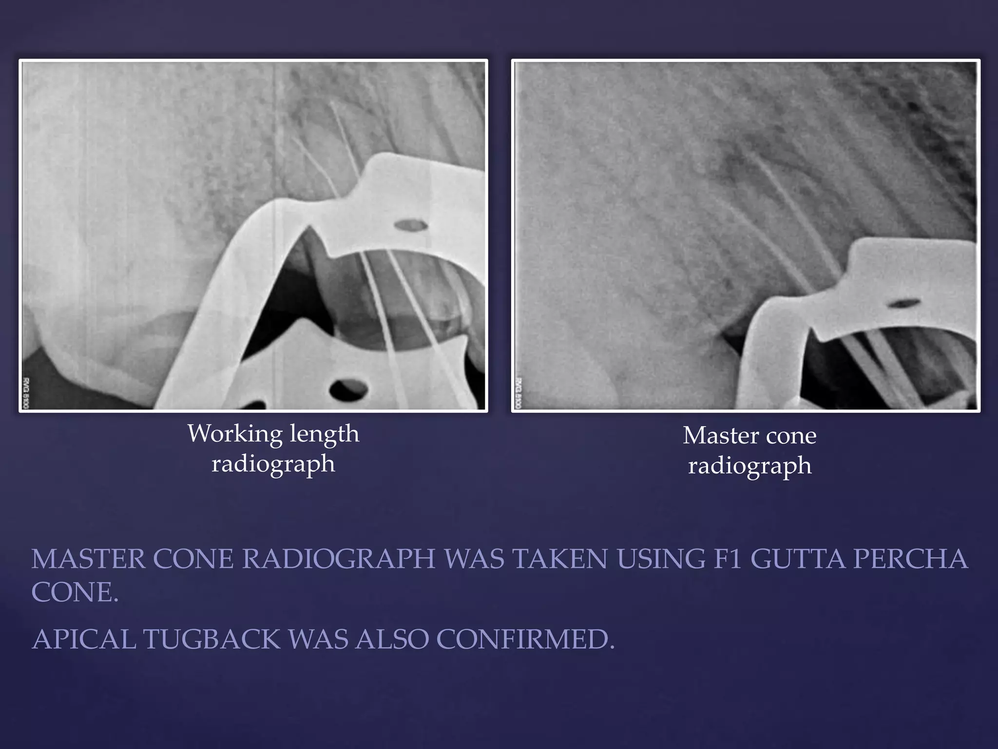manegment of intraoral sinus in single sitting endodontics | PPTX