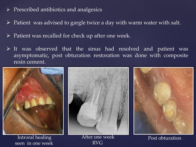 manegment of intraoral sinus in single sitting endodontics | PPT
