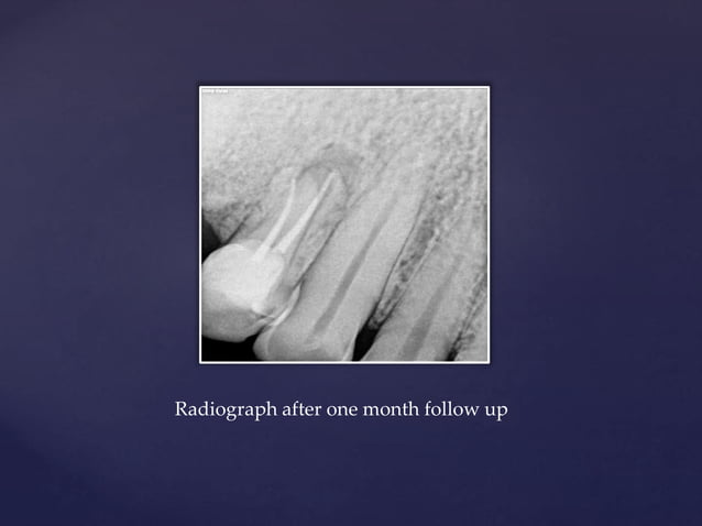 manegment of intraoral sinus in single sitting endodontics | PPTX
