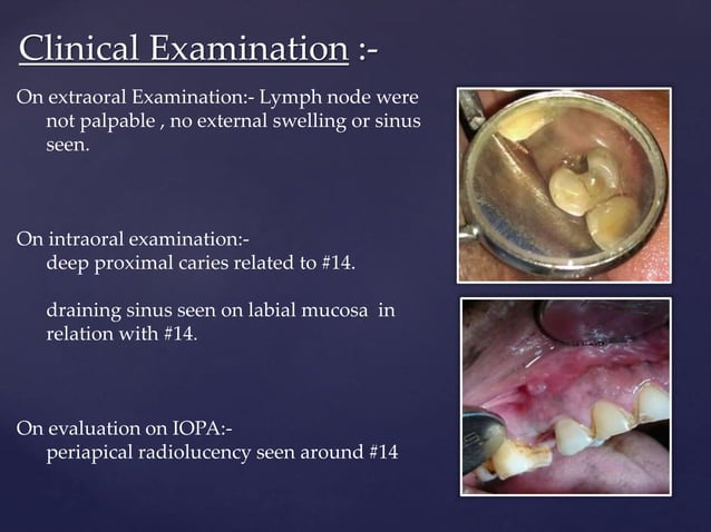 manegment of intraoral sinus in single sitting endodontics | PPTX