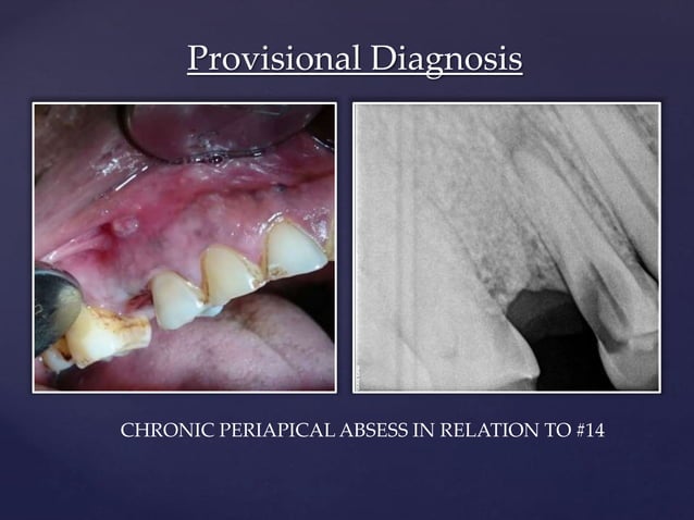 manegment of intraoral sinus in single sitting endodontics | PPTX