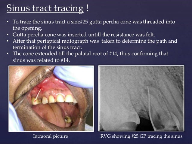 manegment of intraoral sinus in single sitting endodontics