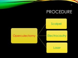 Operculectomy