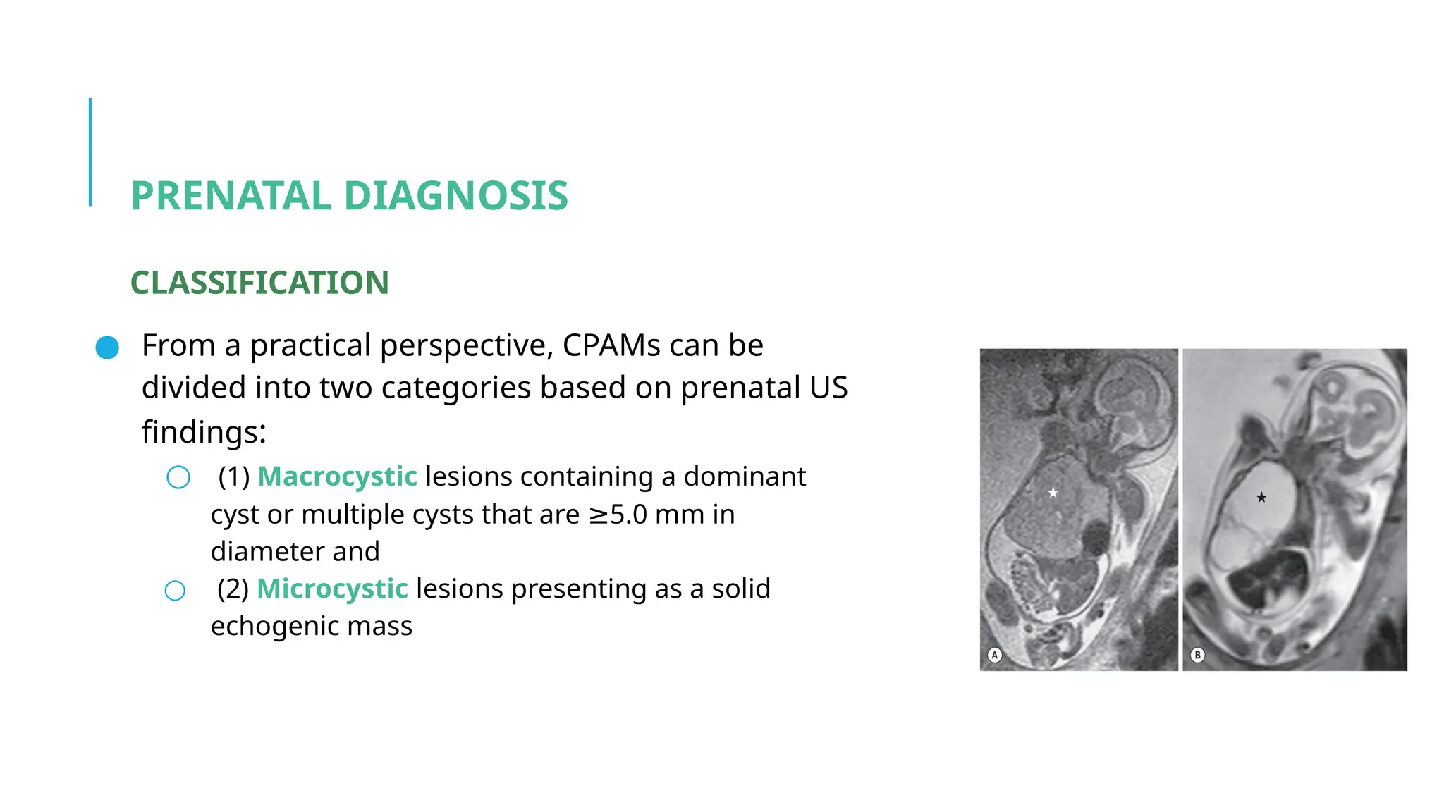CPAM and CLE diagnosis and management .pptx