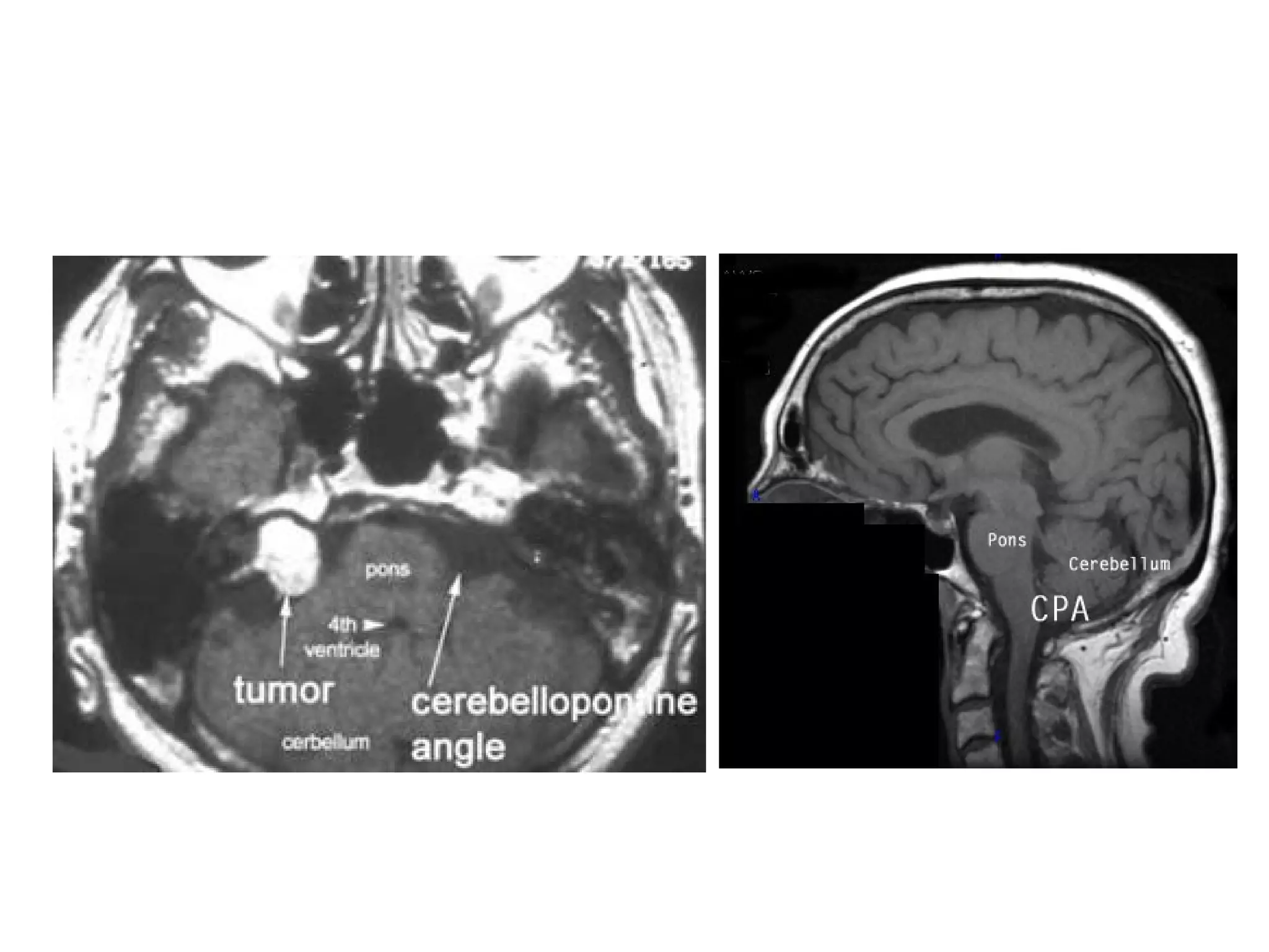 Diagnostic Imaging of Cerebellopontine Angle Masses | PPT
