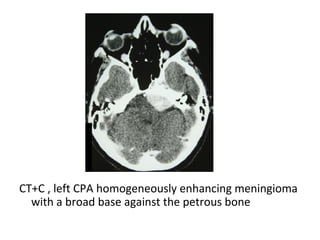 Diagnostic Imaging of Cerebellopontine Angle Masses | PPT