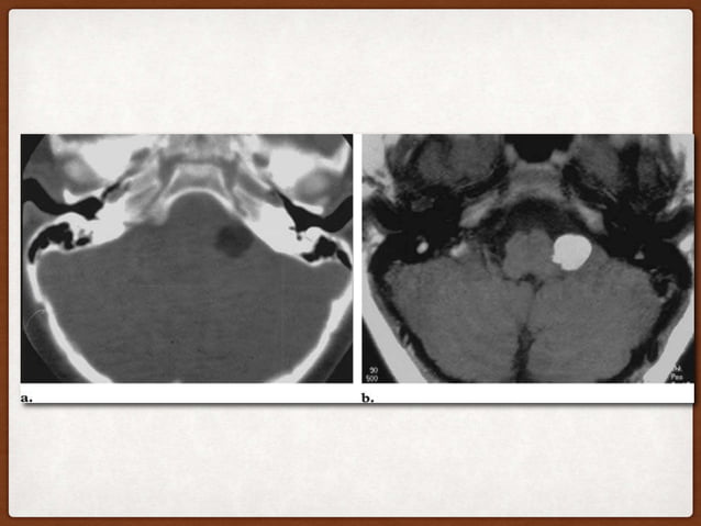CP angle lesions .pptx