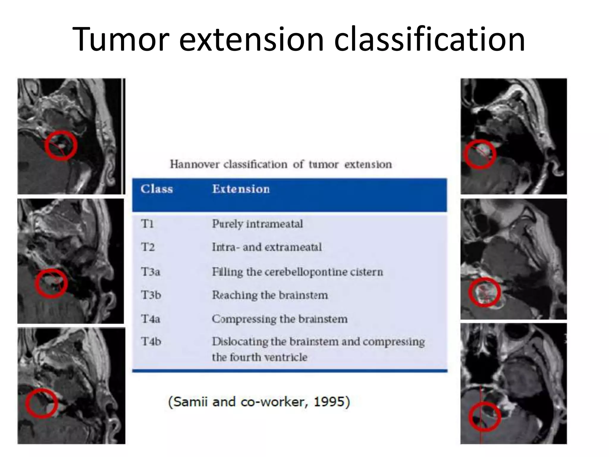 CP ANGLE TUMOR.pptx