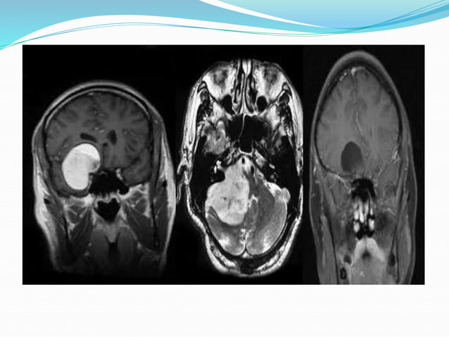 Cp angle tumors | PPTX