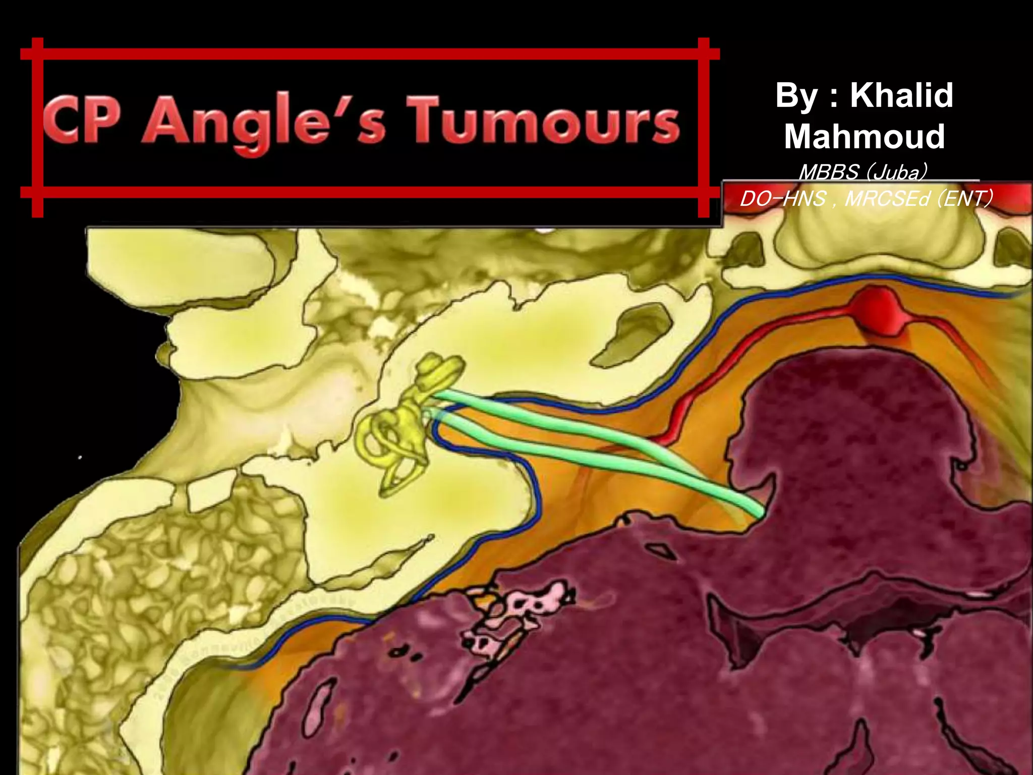 Cp angle tumours | PPTX