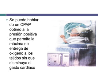 Cpap | PPTX