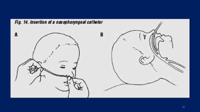 CPAP,.pptx neonatal non invasive ventilation | PPT