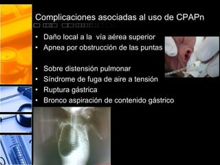 Cpap nasal | PPTX