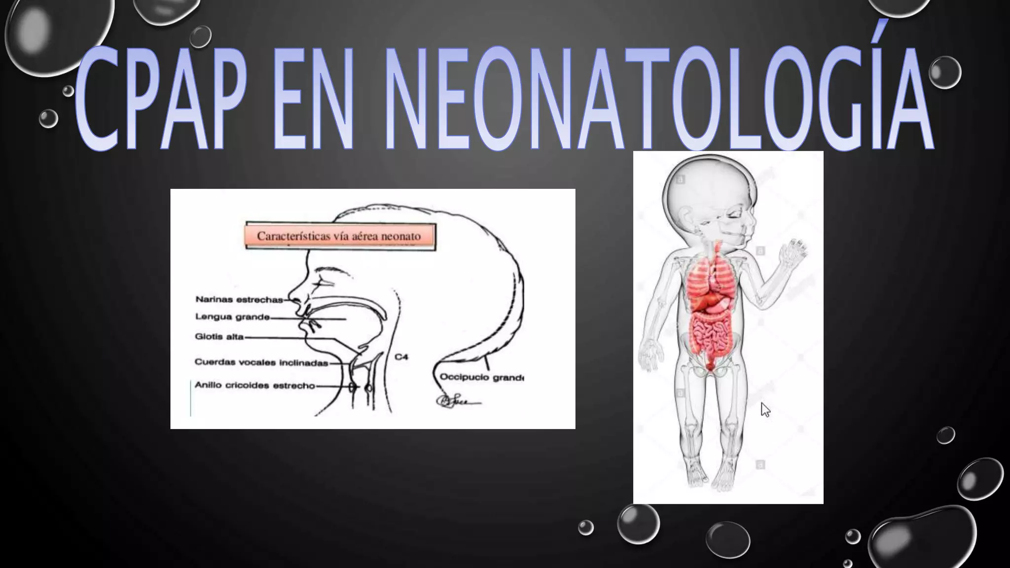 CPAP, VENTILACION MECANICA, MONITORIIZACION DE SV EN NEONATOS | PPT