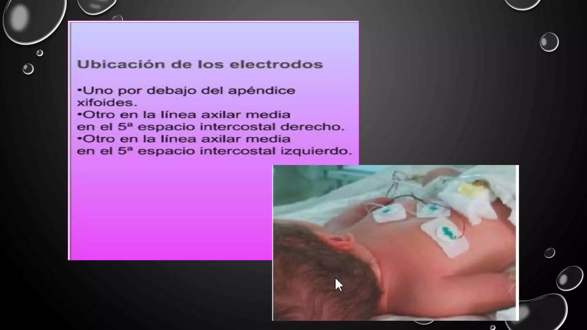 CPAP, VENTILACION MECANICA, MONITORIIZACION DE SV EN NEONATOS | PPT