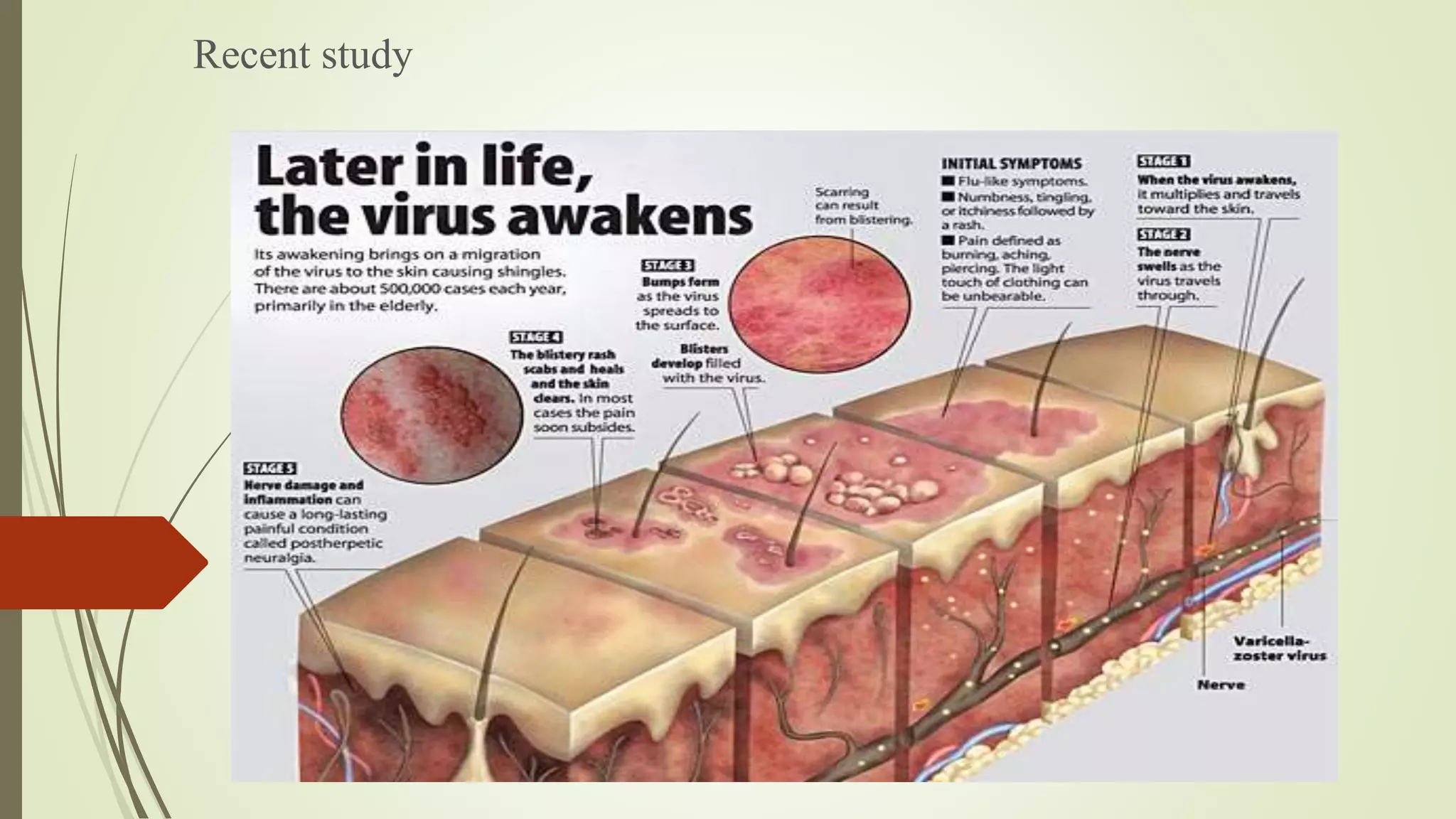 Chickenpox: Pathophysiology | PPTX