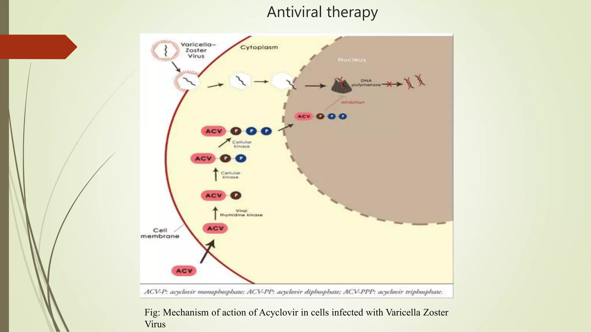 Chickenpox: Pathophysiology | PPTX
