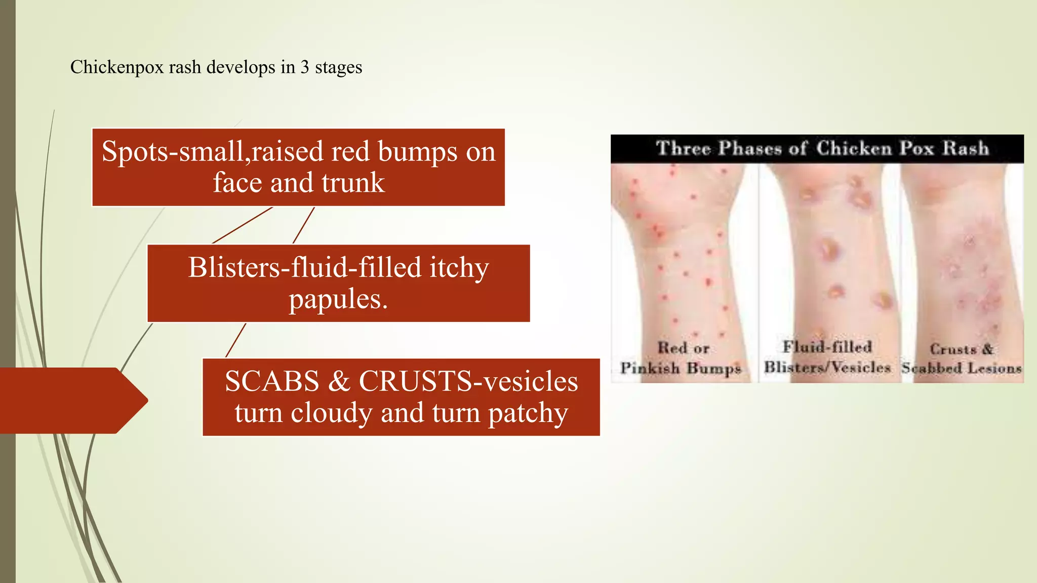 Chickenpox: Pathophysiology | PPTX