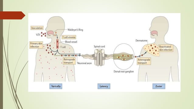Chickenpox: Pathophysiology | PPTX