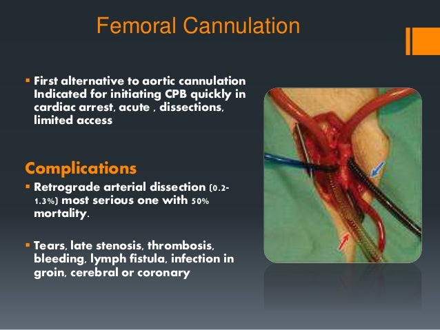 Cardiopulmonary Bypass