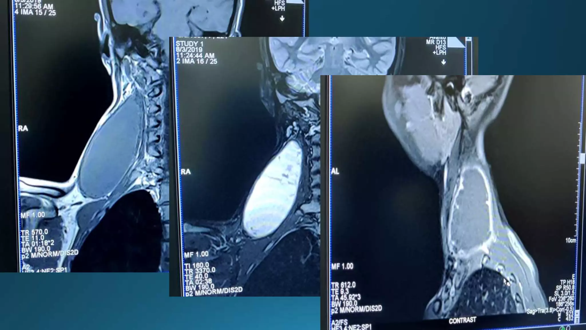 Case Presentation Branchial Cyst | PPTX