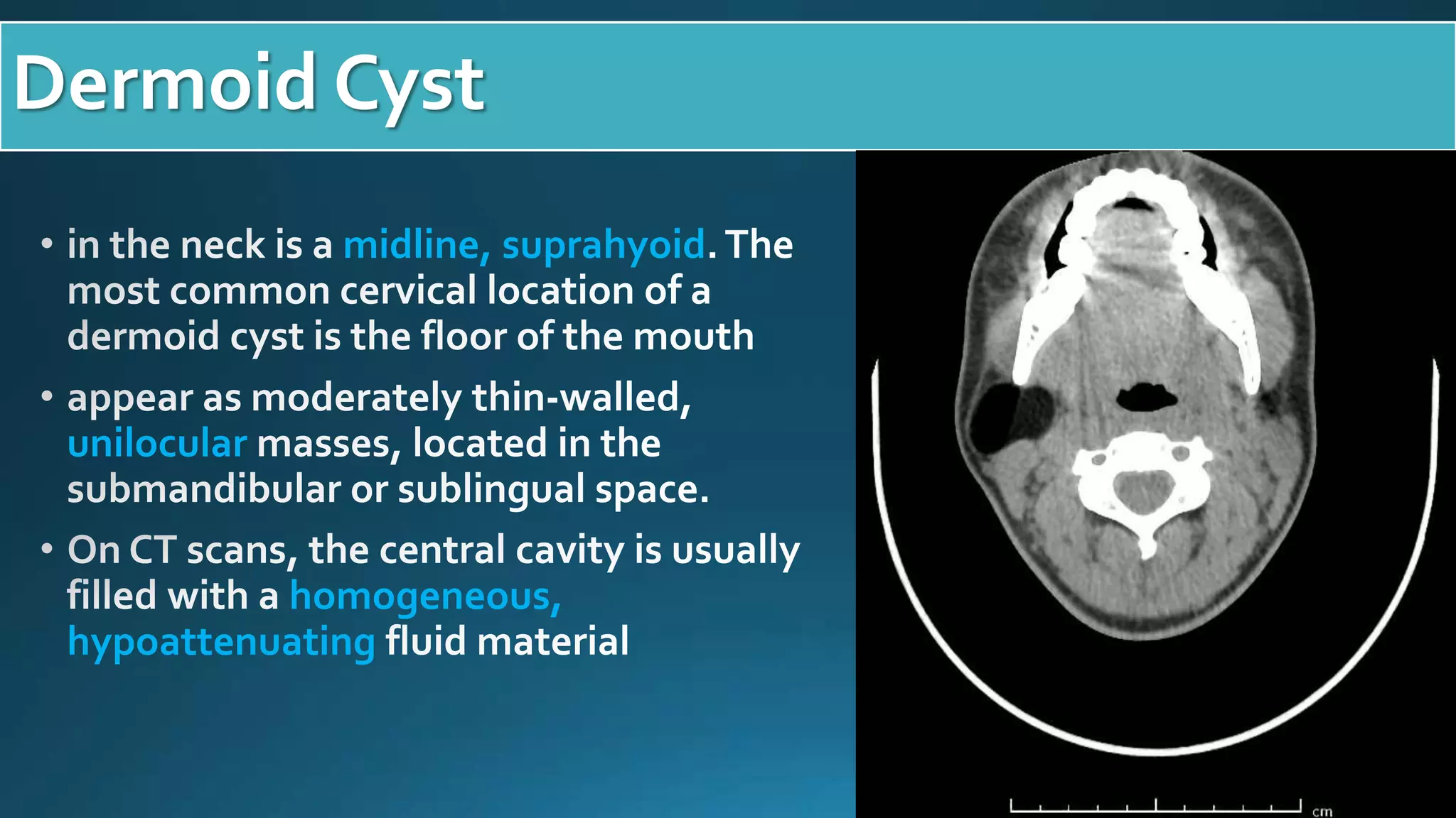 Case Presentation Branchial Cyst | PPTX