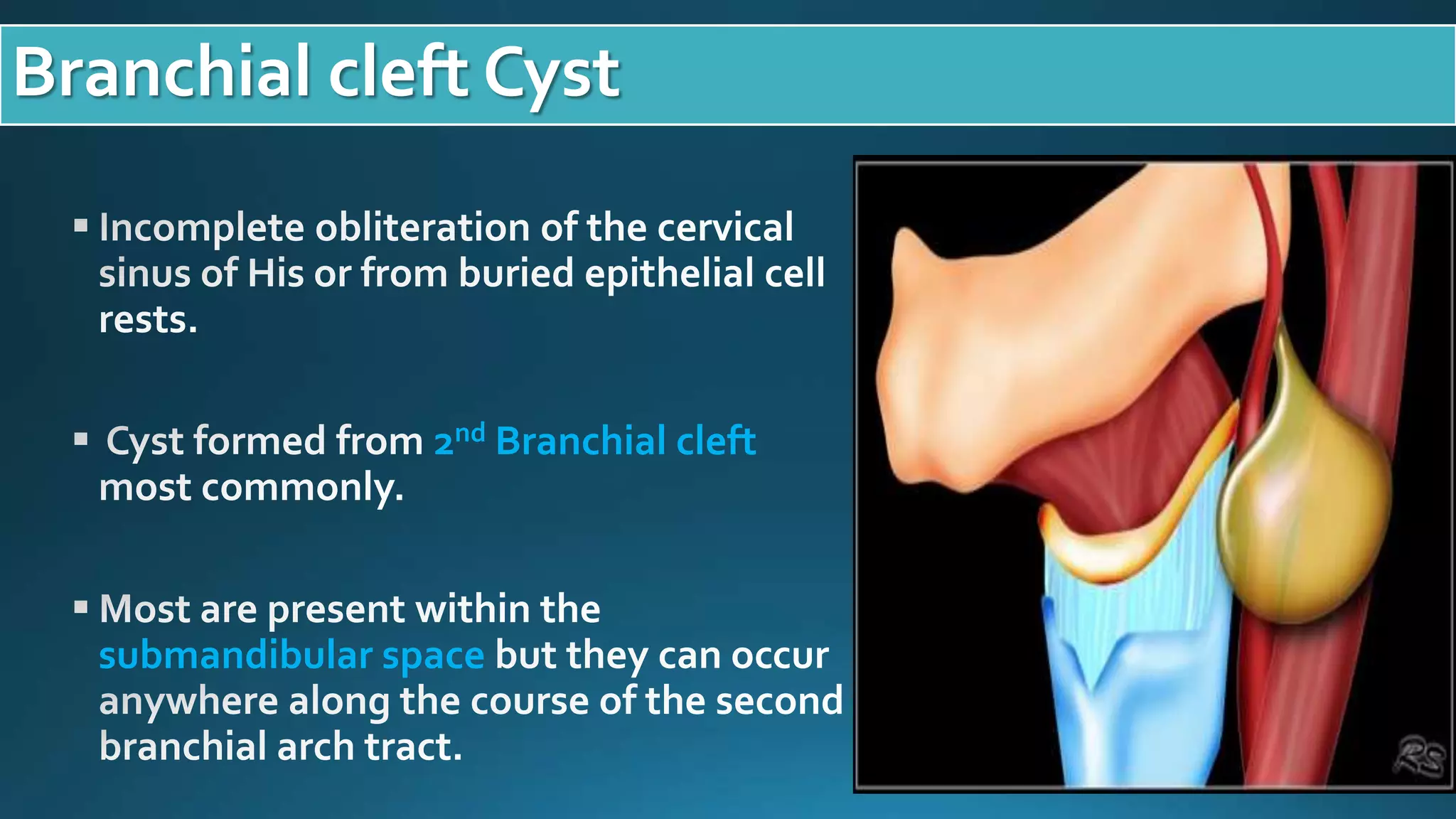 Case Presentation Branchial Cyst | PPTX