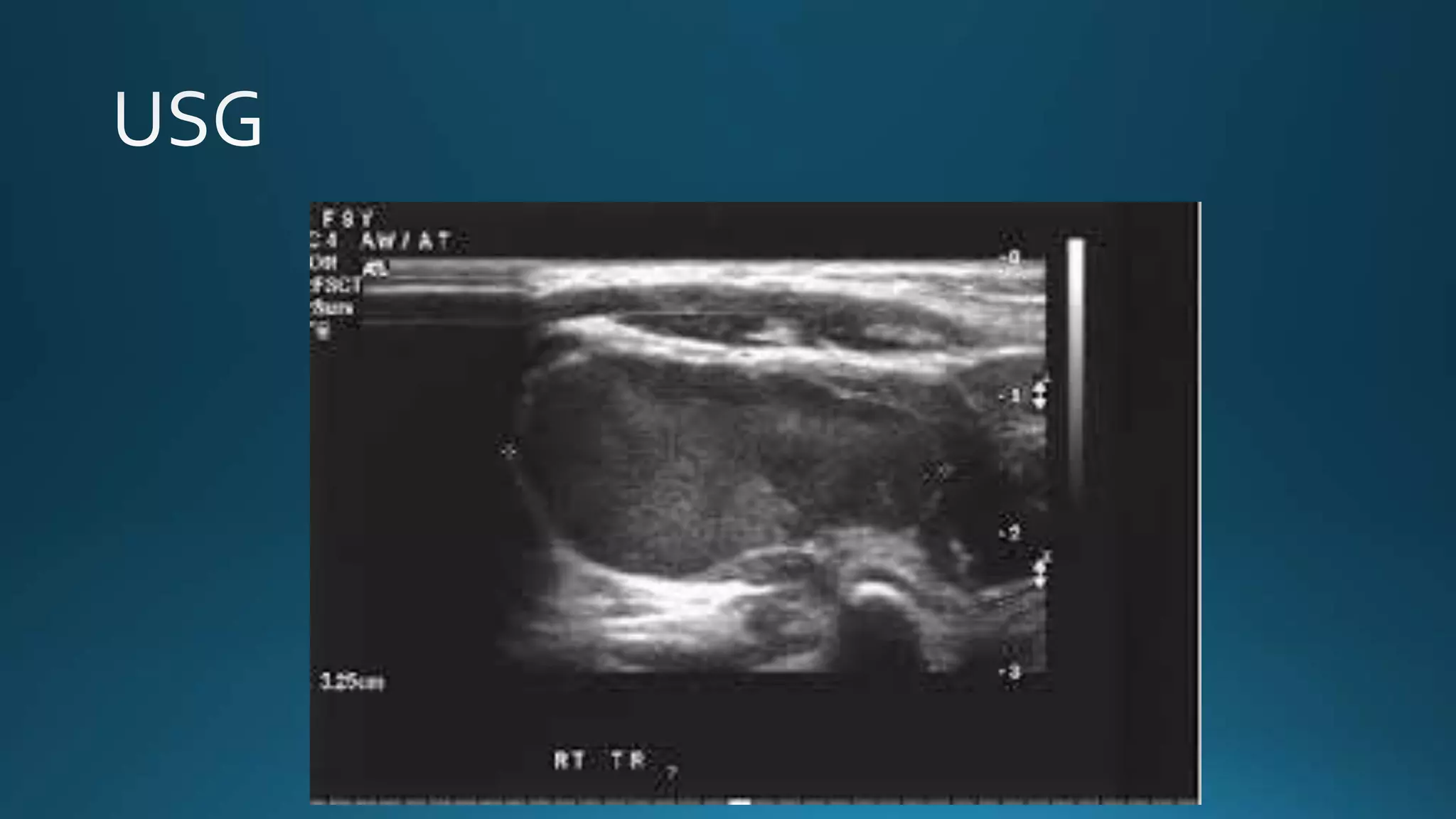 Case Presentation Branchial Cyst | PPTX