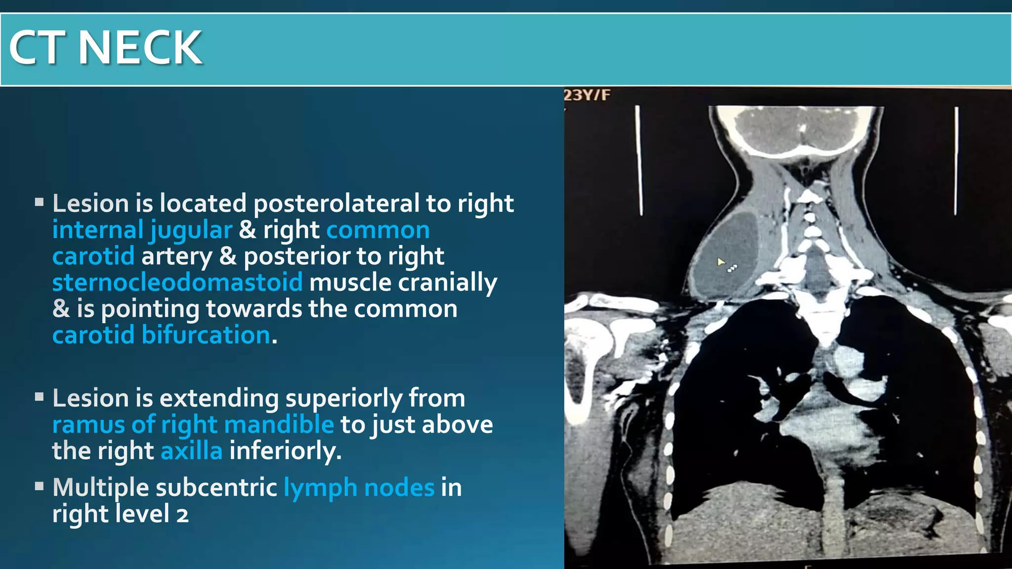 Case Presentation Branchial Cyst | PPTX