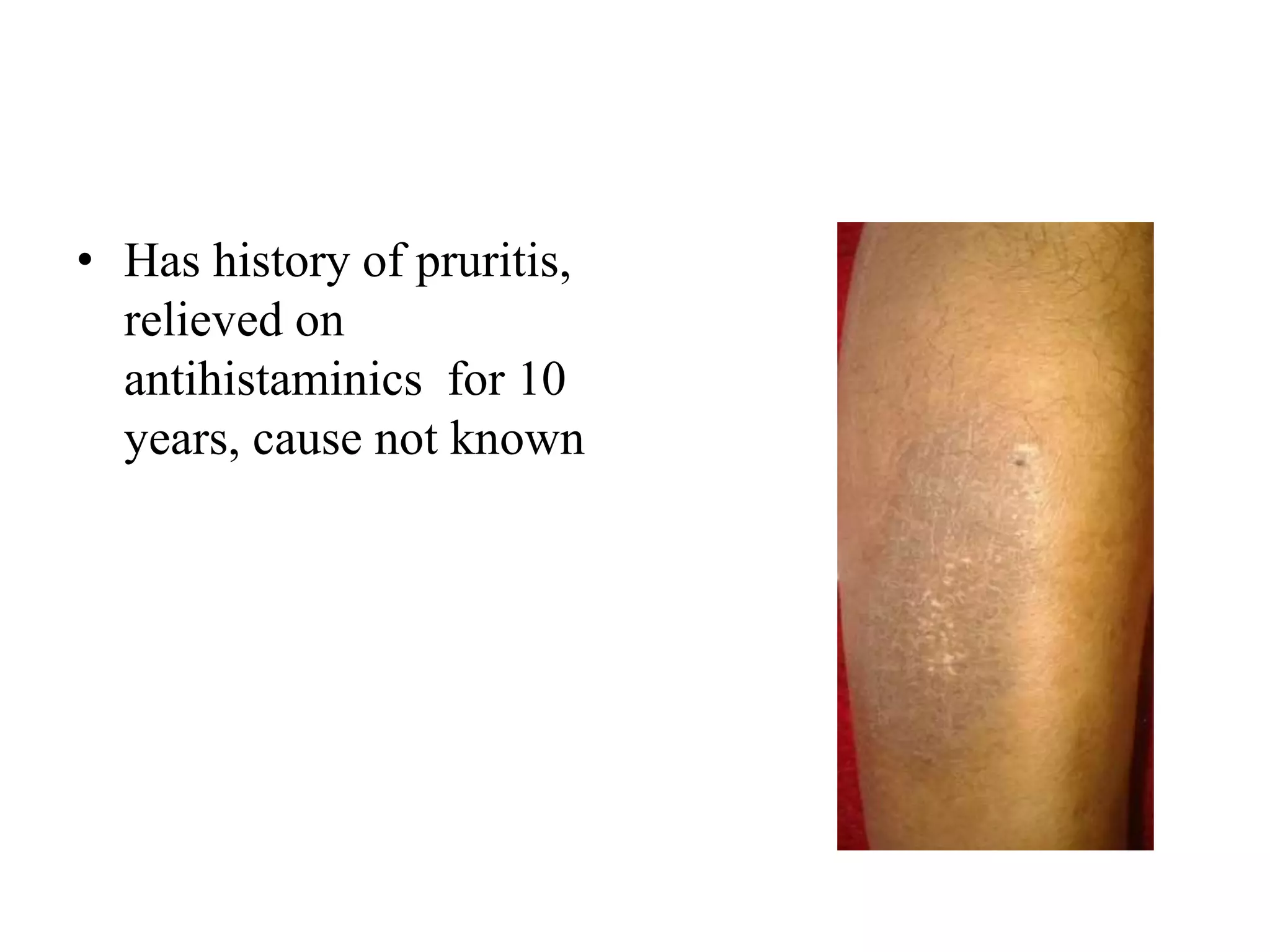 Cinicopathological Meeting- Intestinal Ganglioneuromatosis | PPT