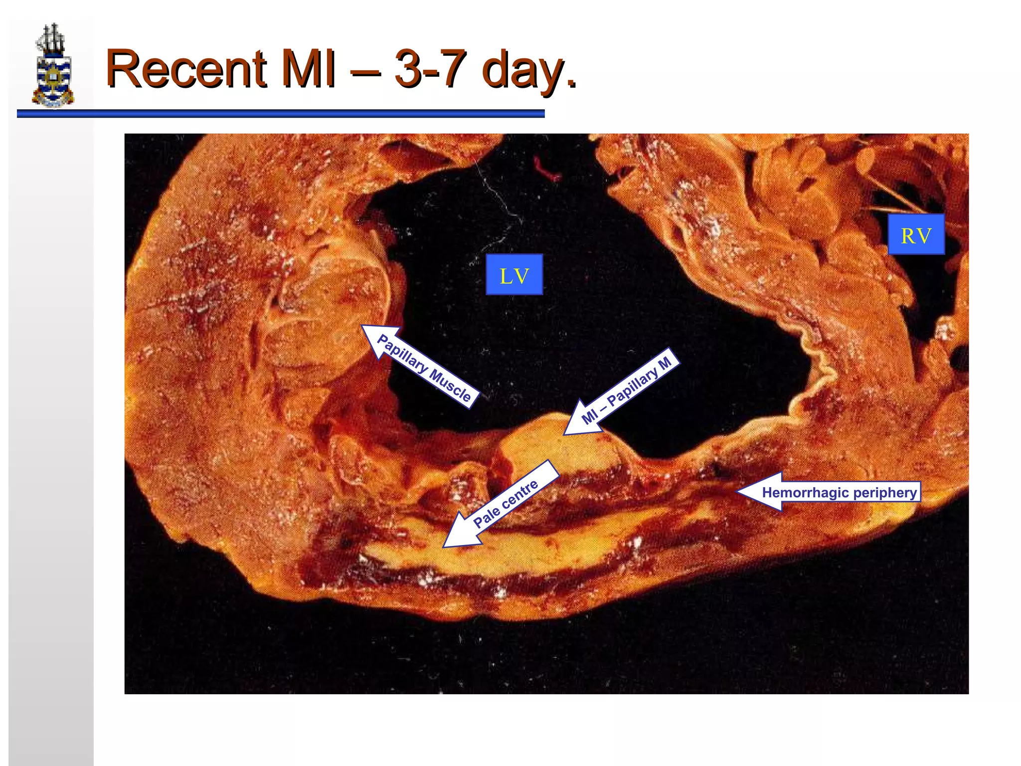 Pathology of Myocardial Infarction | PPT