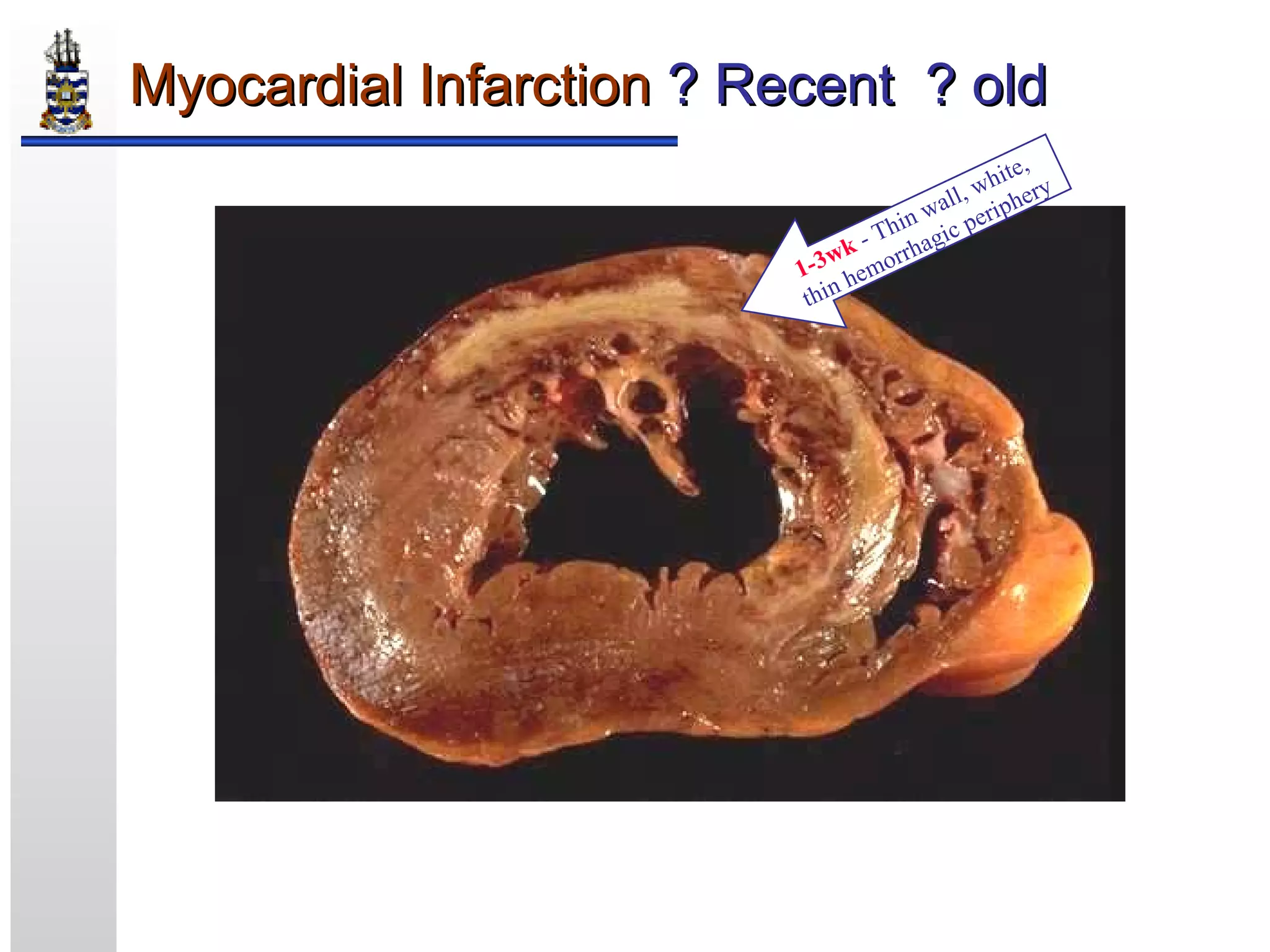 Pathology of Myocardial Infarction | PPT