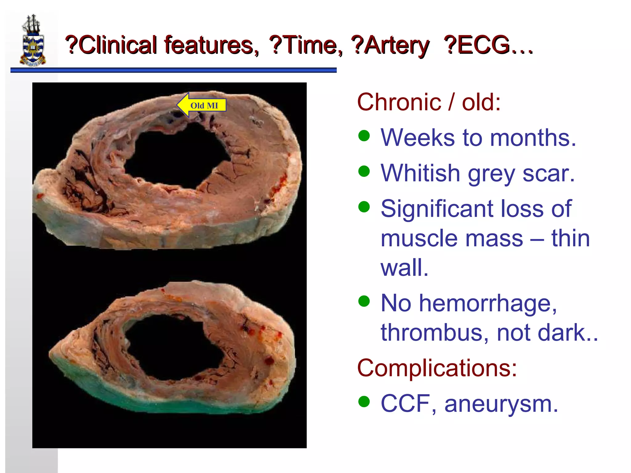 Pathology of Myocardial Infarction | PPT