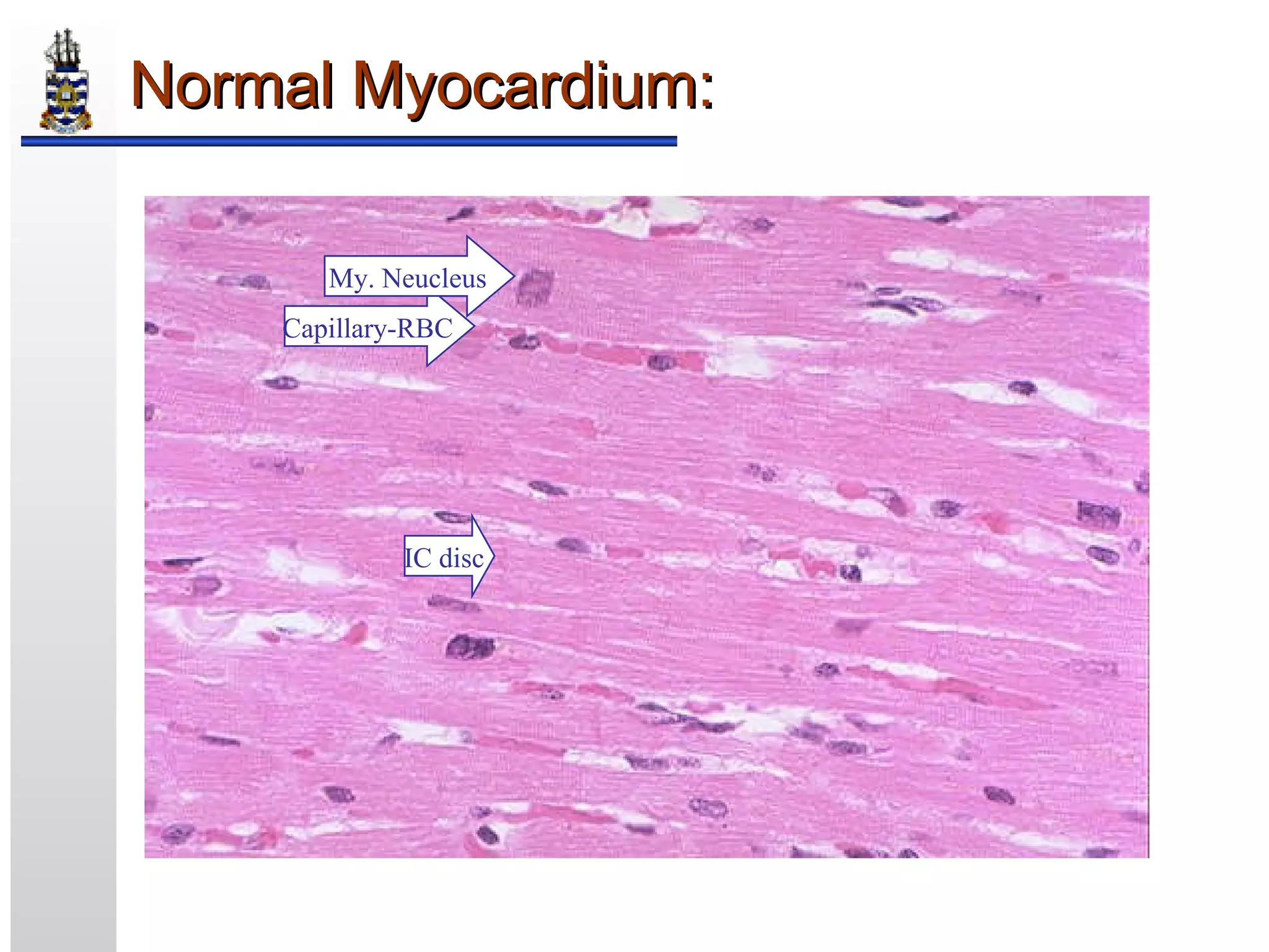 Pathology of Myocardial Infarction | PPT