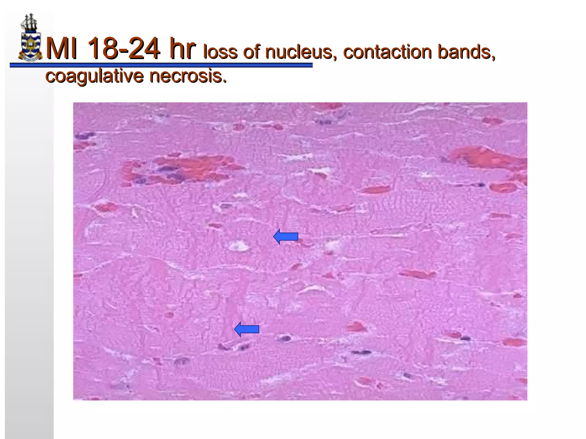 Pathology of Myocardial Infarction | PPT