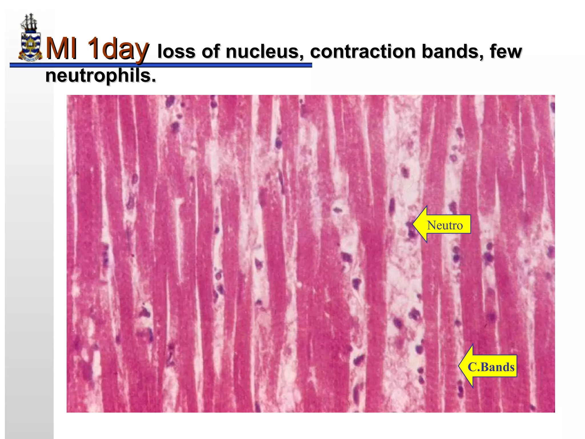 Pathology of Myocardial Infarction | PPT