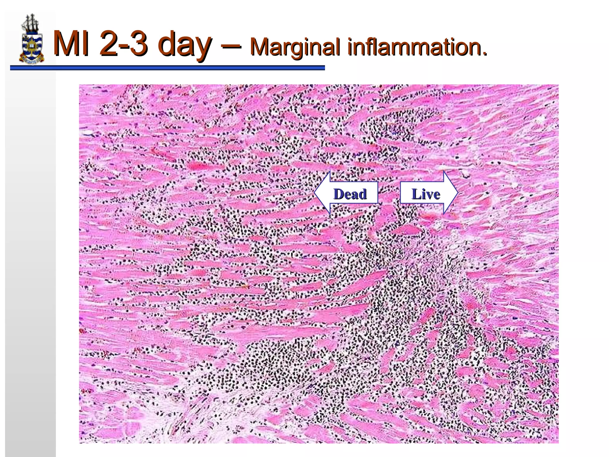 Pathology of Myocardial Infarction | PPT