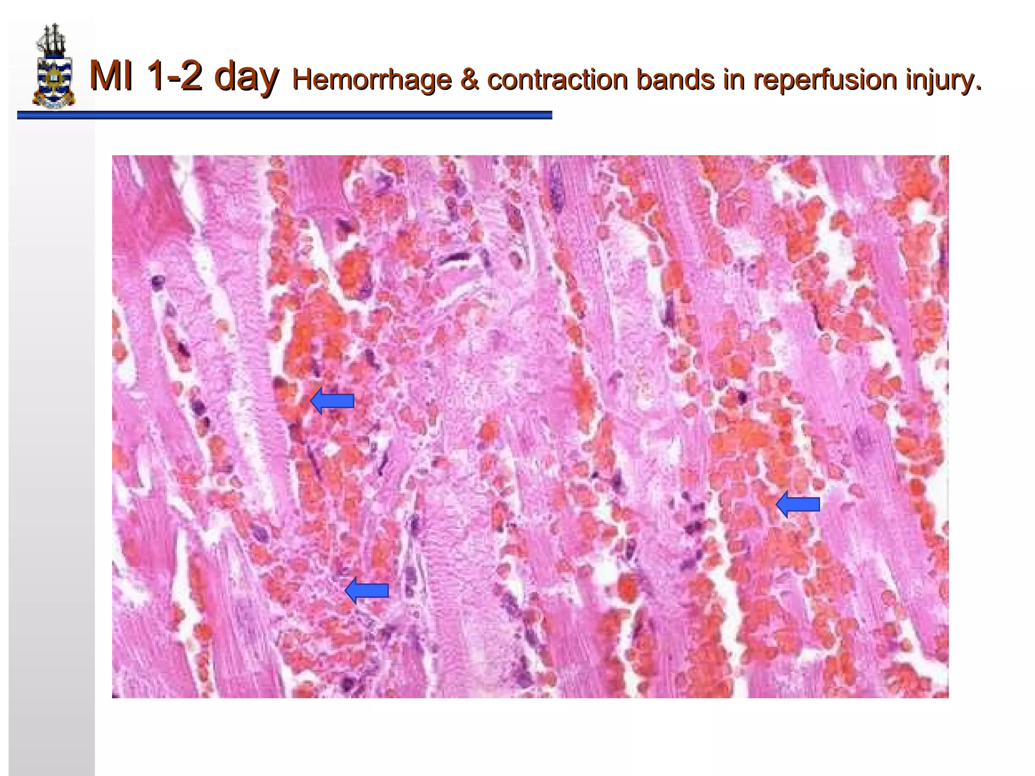 Pathology of Myocardial Infarction | PPT