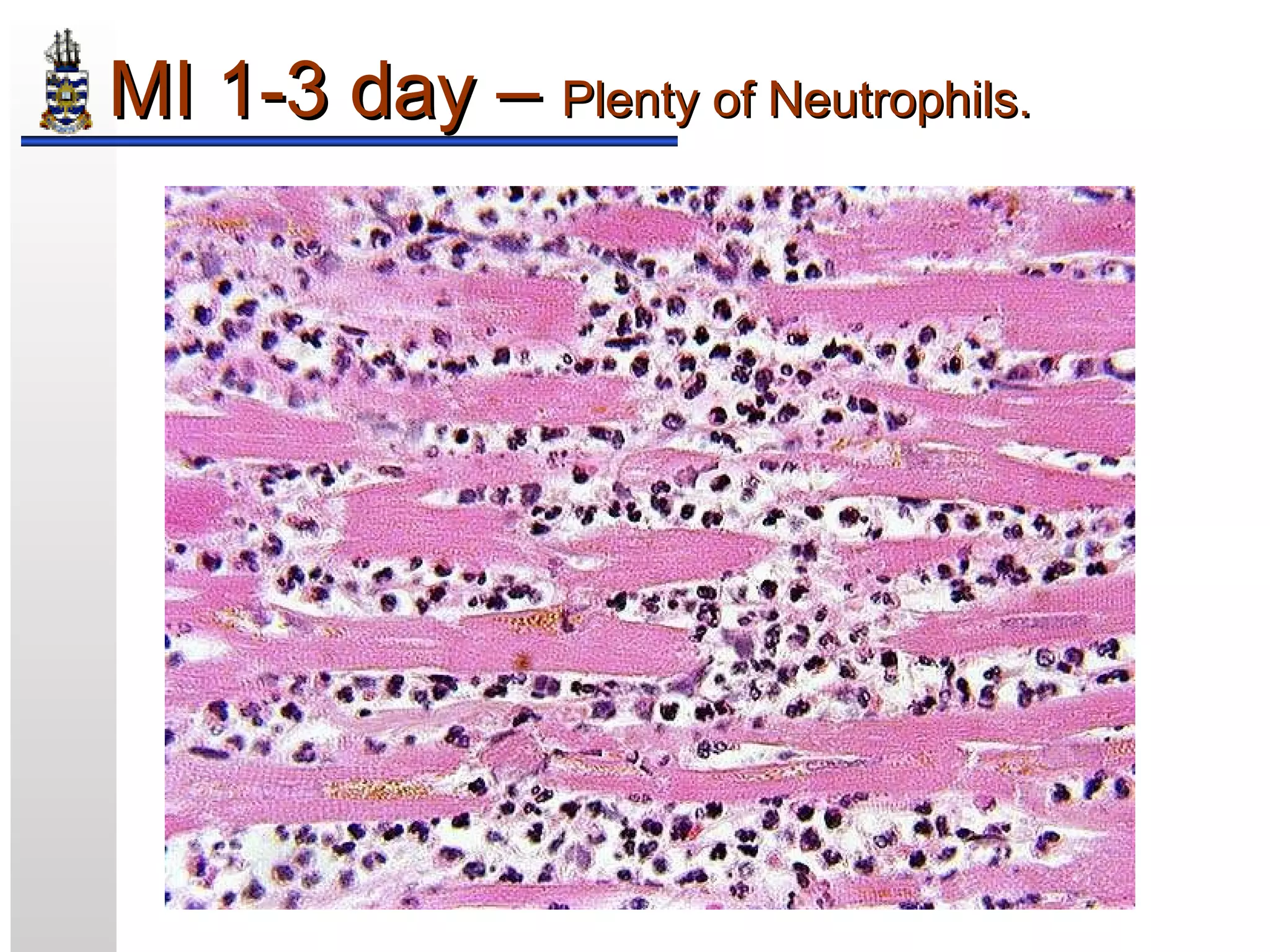 Pathology of Myocardial Infarction | PPT
