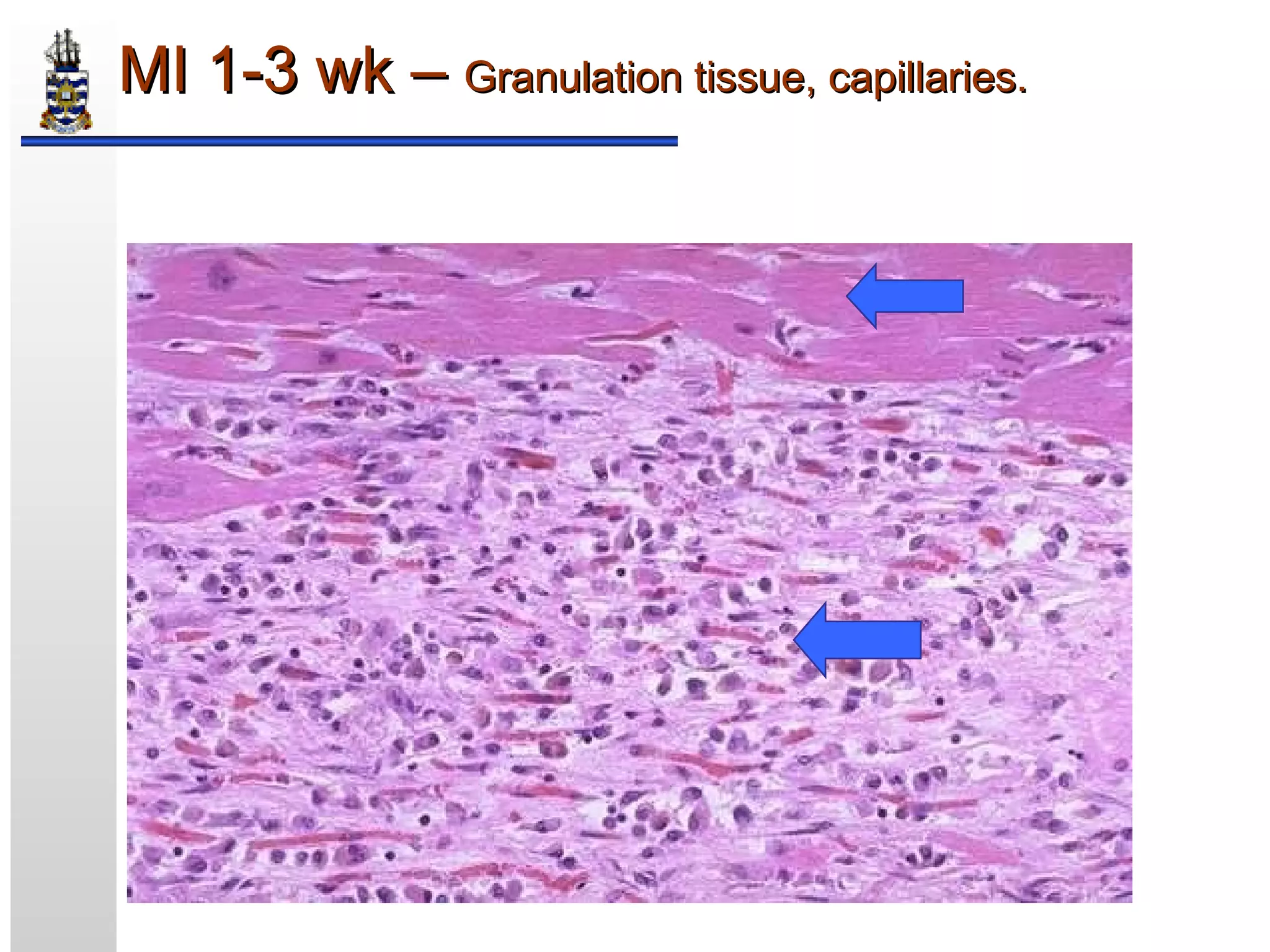 Pathology of Myocardial Infarction | PPT